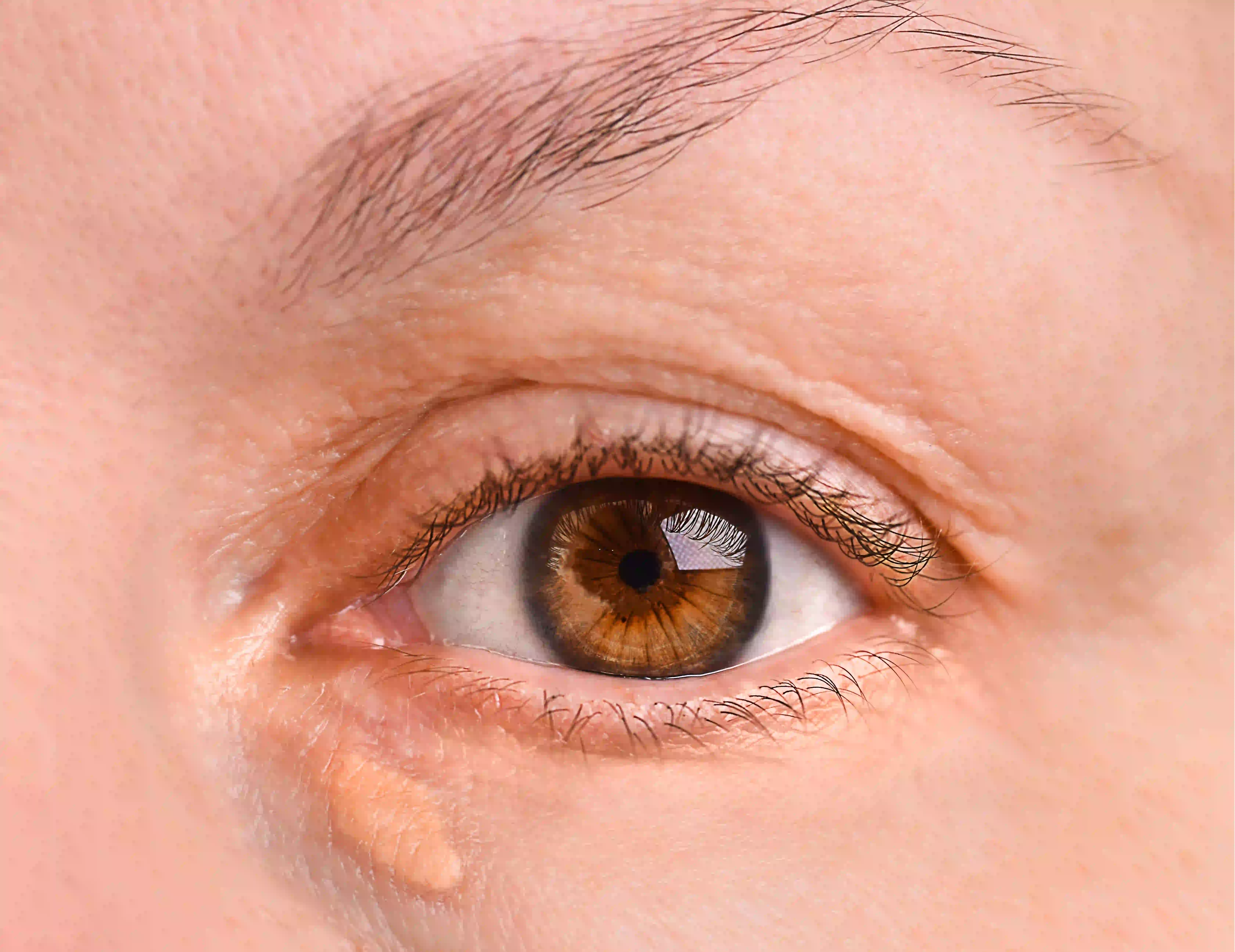 Xanthelasma: Penyebab, Gejala, Pengobatan, & Pencegahan - JEC Eye ...