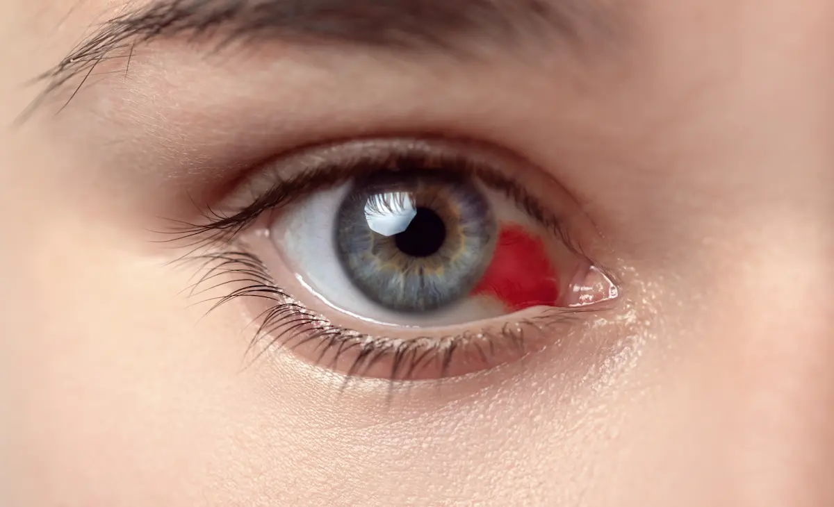 Apakah Kornea Mata Robek Bisa Sembuh? Ini Penjelasannya - JEC Eye ...