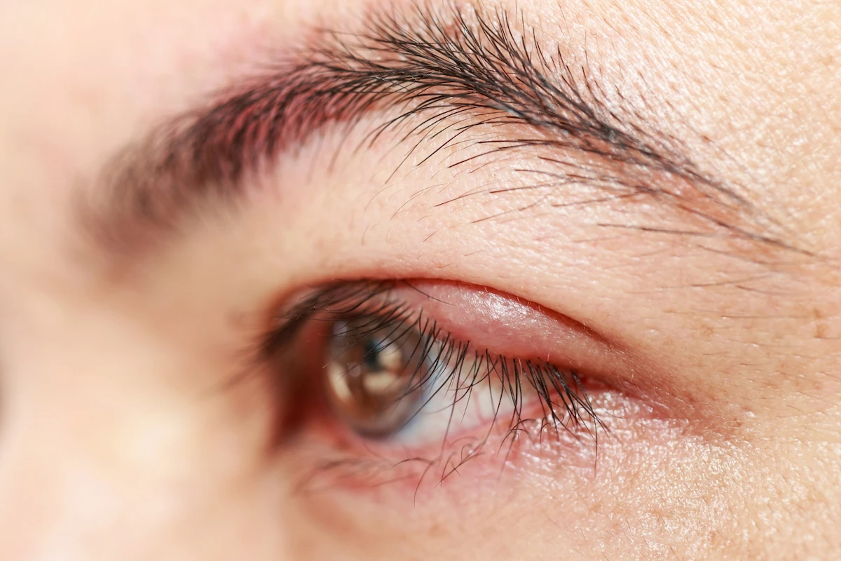 Kalazion - Penyebab, Gejala, Diagnosis, dan Cara Mengobatinya - JEC Eye ...
